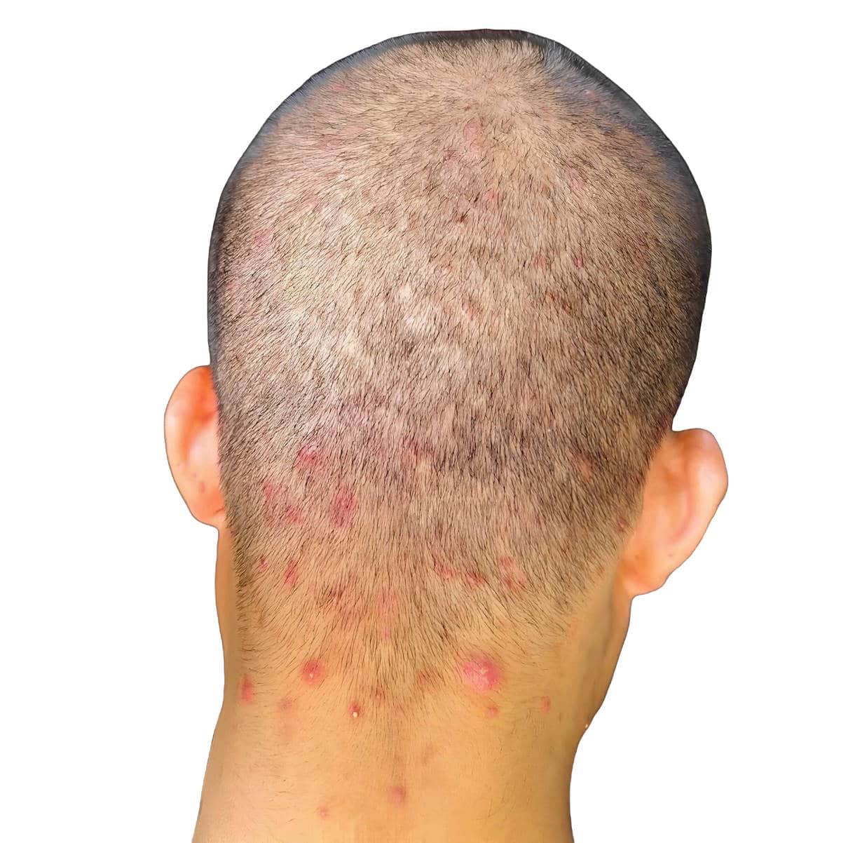 פצעים בקרקפת - BeBelle